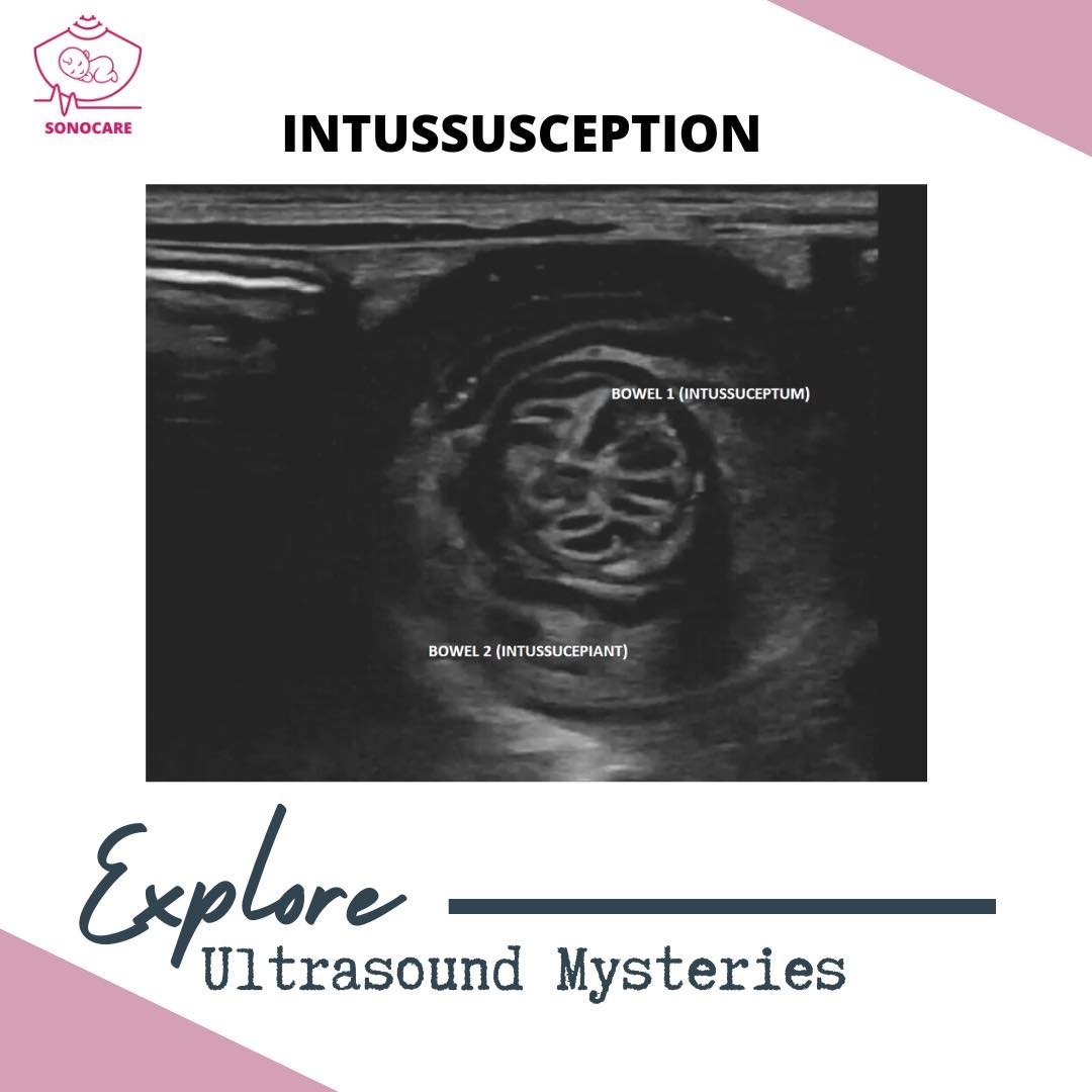 19/11/2022 What is Intussusception? – Newpages Network Sdn. Bhd.